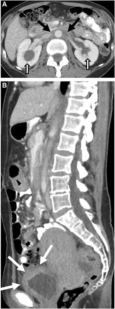 48 Year Old Women Who First Presented With Metastatic Invasive Lobular