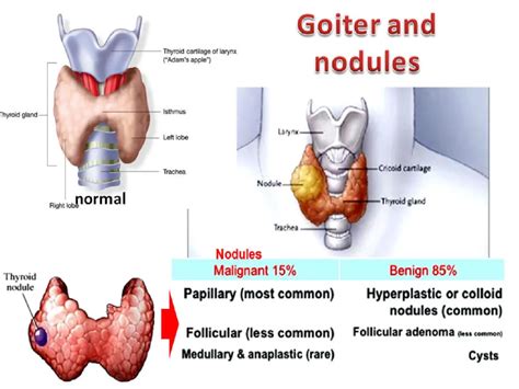 Goiters And Thyroid Nodules Key Differences Causes