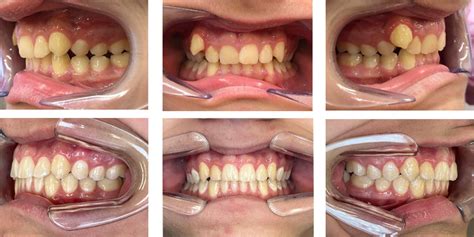 Invisalign Complex Cases