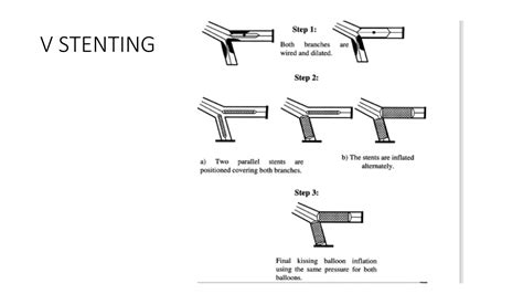 Classification Of Bifurcation Lesion Angioplasty Pptx