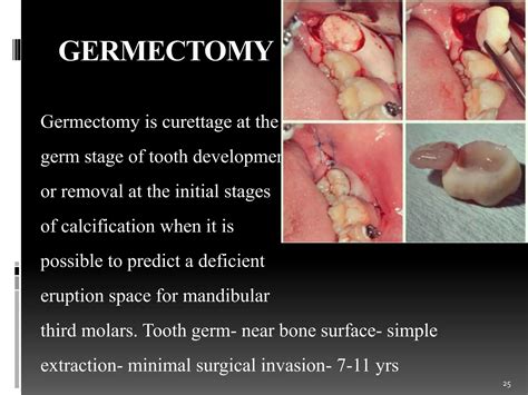 Surgical Extraction Of Mandibular Third Molar Pptx