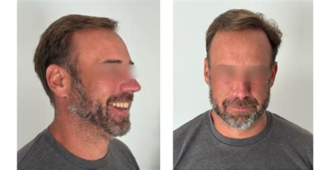 Botox And Xeomin Balanced Soul Wellness Jacksonville Fl