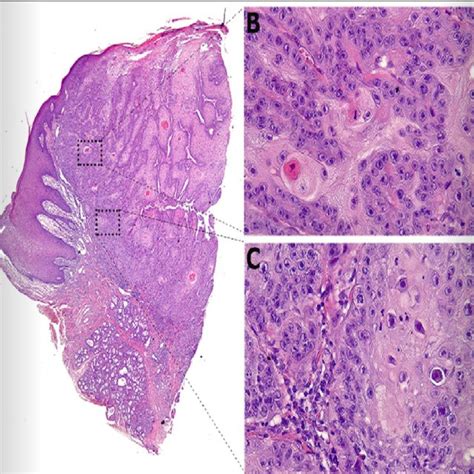 A Exophytic Lesion In The Lateral Of The Lip Vermelion In The Case 2