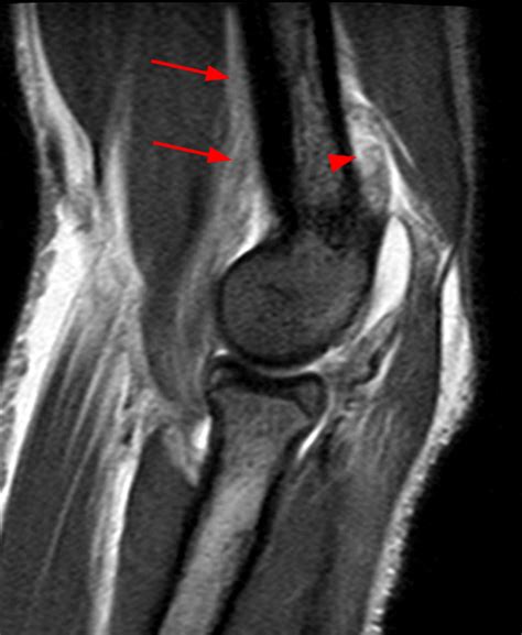 Pediatric Elbow Dislocation Radsource