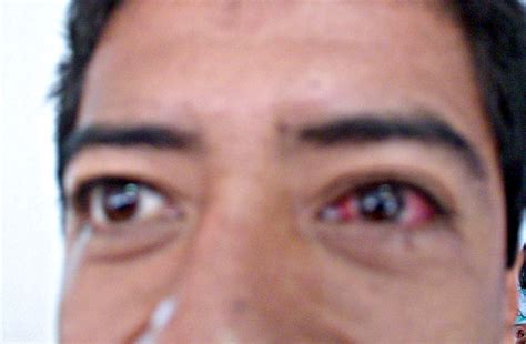 Tabasco Registra 192 Casos De Conjuntivitis Hemorrágica