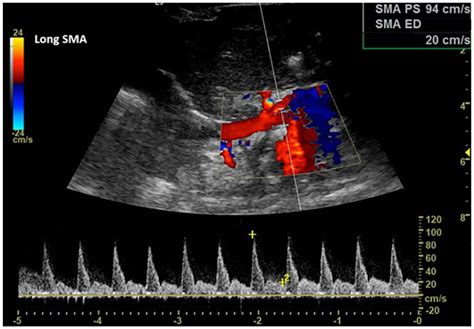 Sonographic Detection Of Congenital Intestinal Malrotation A Case