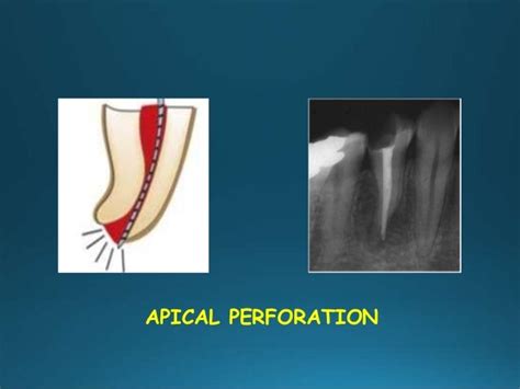 Endodontic Instruments 2