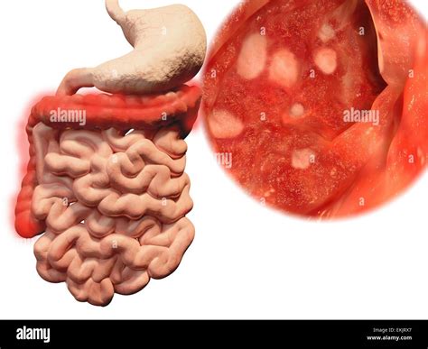 Ulcerative Colitis Colonoscopy