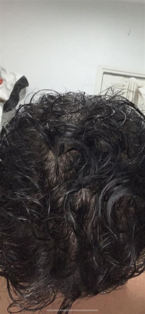 Diffuse Hair Loss After Acne Treatment Rtelogeneffluvium