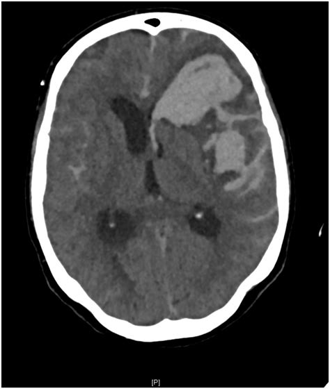 Ct Scan On The Day Of Admission Shows Subarachnoid Bleeding Centered Download Scientific