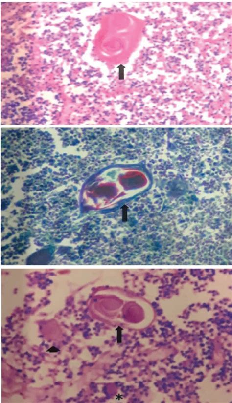 A Hematoxylin And Eosin X400 Fusiform Type Of Hc Seen Containing