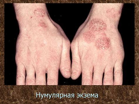 Дерматит Экзема презентация онлайн