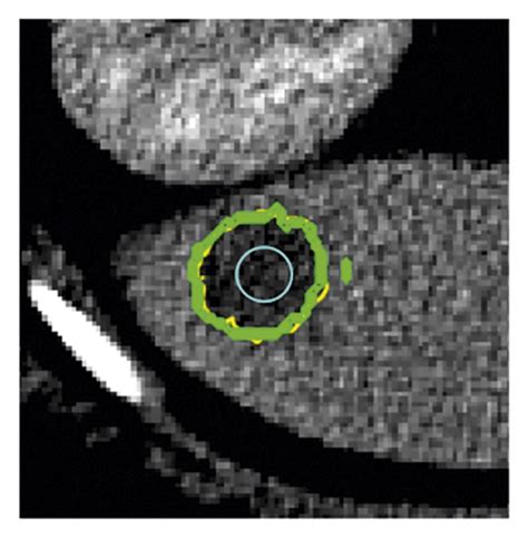 Tumor Segmentation Using The Proposed Method Drls With Two Different