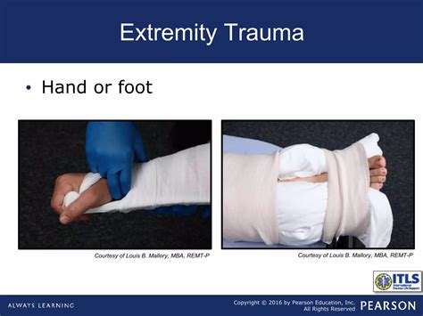Chapter14 Extremity Trauma Ppt