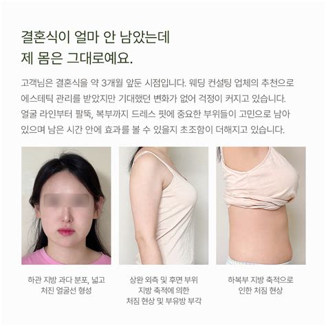 A Magazine For U Vol05 웨딩이나 중요한 일정을 앞둔 고객님들께서 시술을 선택할 때 가장 우려하는 부분은