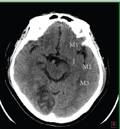 The Mca Territory Is Divided Into 10 Aspects Regions Including Caudate Download Scientific