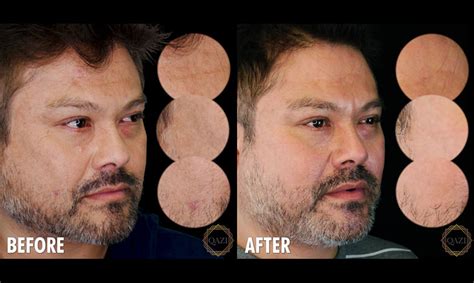 Is Hyperpigmentation Permanent