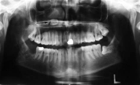 Panoramic Radiograph Showing An Ovoid Intranasal Radiopacity Download Scientific Diagram