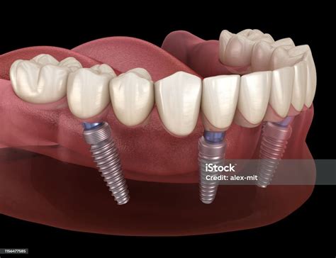 하악 보철은 임플란트에 의해 지원되는 4 개의 시스템에 모두 인간의 치아와 의치 개념의 의학적으로 정확한 3d 그림 치아 임플란트에 대한 스톡 사진 및 기타 이미지 Istock