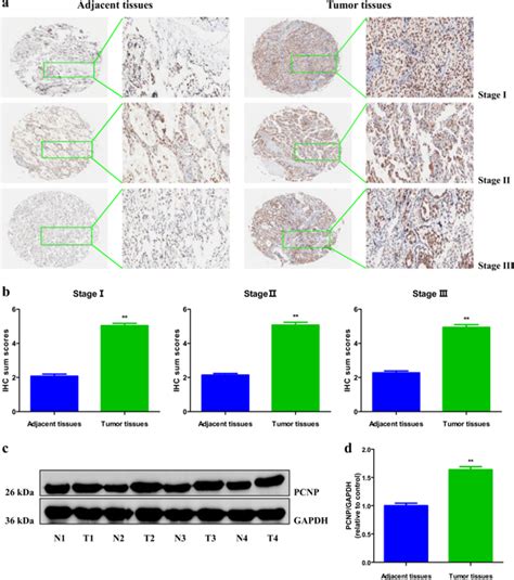 含pest的核蛋白调节肺腺癌中的细胞增殖，迁移和侵袭oncogenesis X Mol