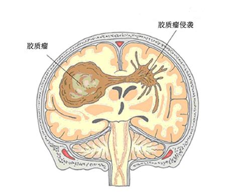 脑胶质瘤治愈率胶质瘤能活多久 哔哩哔哩