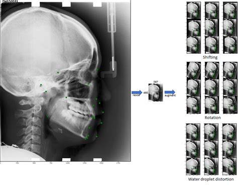 Locating Cephalometric Landmarks With Multi Phase Deep Learning Athenaeum Scientific Publishers
