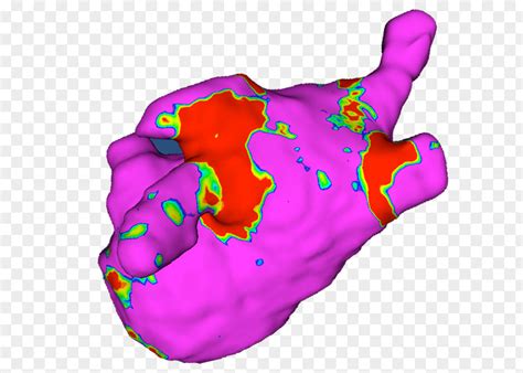 Atrial Fibrillation Heart Arrhythmia Flutter Paroxysmal Tachycardia Png