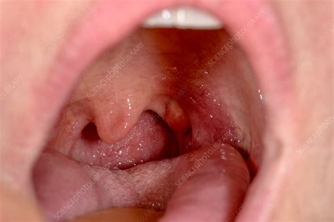 Tonsil Cyst Stock Image C0345391 Science Photo Library