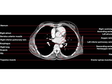 Ct Scan Chest Anatomy