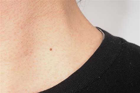 4 రకాల మొటిమలు వాటి కారణాలు మరియు చికిత్స ఎంపికలు