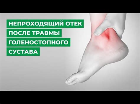 Вывих стопы: лечение в домашних условиях