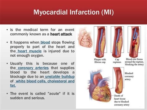 Case Presentation Myocardial Infarction