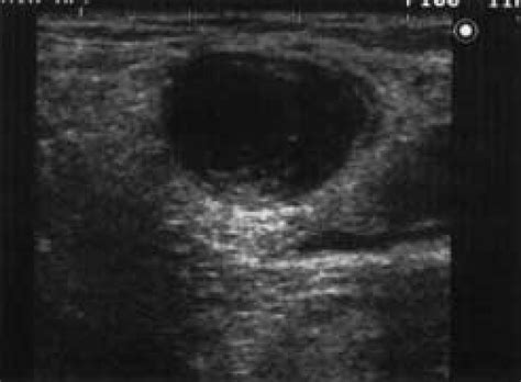 Ultrasound Sonography With Compression Shows The Thrombus In The Long