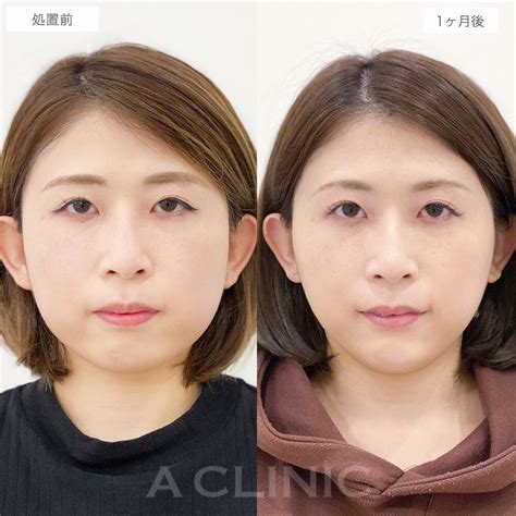 脂肪吸引でしっかり小顔効果を実感♪1day小顔脂肪吸引の処置前と1ヶ月後の症例です20代女性 顔の脂肪吸引・糸リフト専門の美容整形