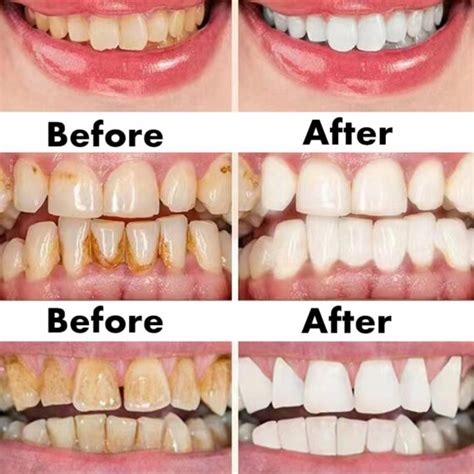 Ceoerty Gum Shield Therapy Gel Lulunami