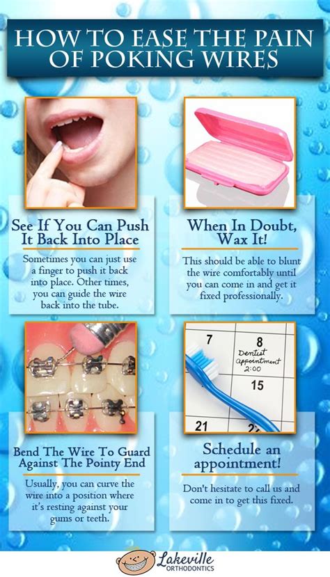 17 Best Images About Brace Yourself On Pinterest Lingual Braces