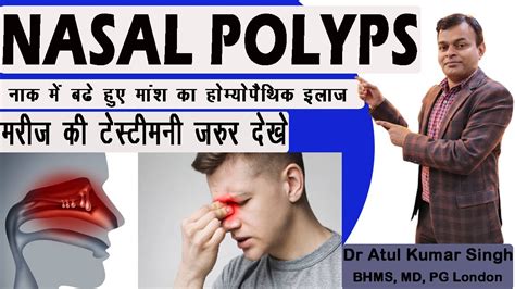 Nasal Polyp Nasal Polyp Treatment Without Surgery नाक के पॉलिप का