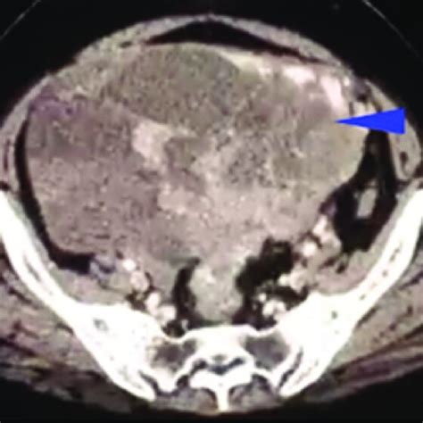 Cect Pelvis Showing Heterogeneous Ovarian Mass Cect Contrast Enhanced