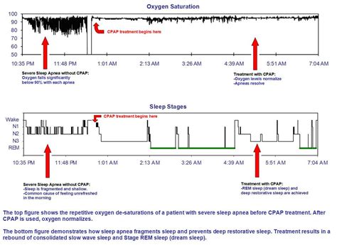 What Is A Titration Study For Sleep Apnea At Indiana Seery Blog