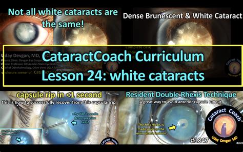 1847 Curriculum Lesson 24 White Cataracts Cataract Coach