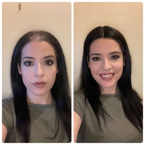 Normal Hairline For Women