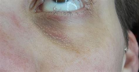 What Are The Bumps And Discoloration Under My Eye Album On Imgur