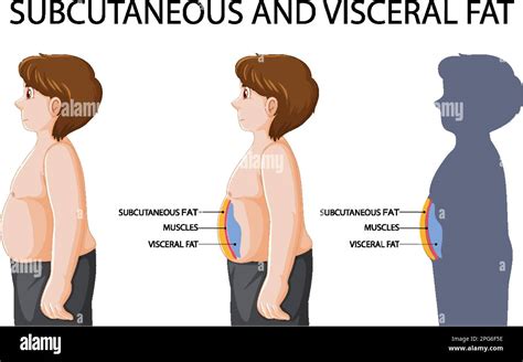 Subcutaneous And Visceral Fat Diagram Illustration Stock Vector Image