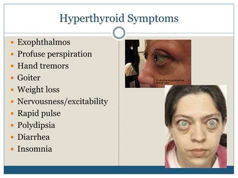 Ppt Thyroid Disorders Powerpoint Presentation Free Download Id 4435536