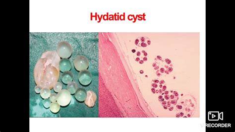 Echinococcus Youtube