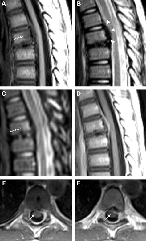 Intervertebral Disc Calcification Radiology At Harry Reese Blog