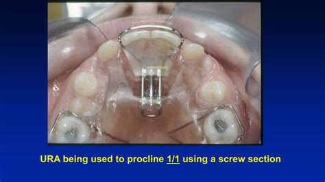 Transverse Malocclusion Crossbite Pptx