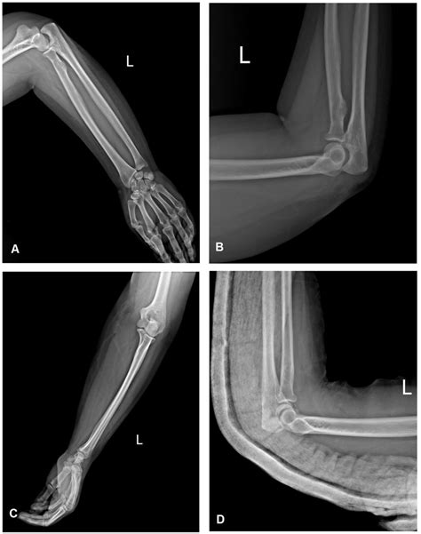 Radiographs Of The Elbow Joint For Diagnosis Of Dislocation A And B