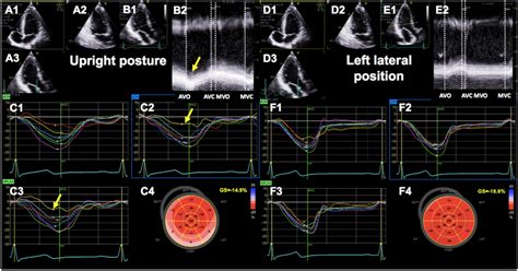 Global Longitudinal Strain Measured By 2d Echocardiography In Upright
