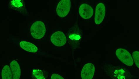 Anti Dsdna Antibodies Could Predict Response To B Cell Targeted Therapies In Sle